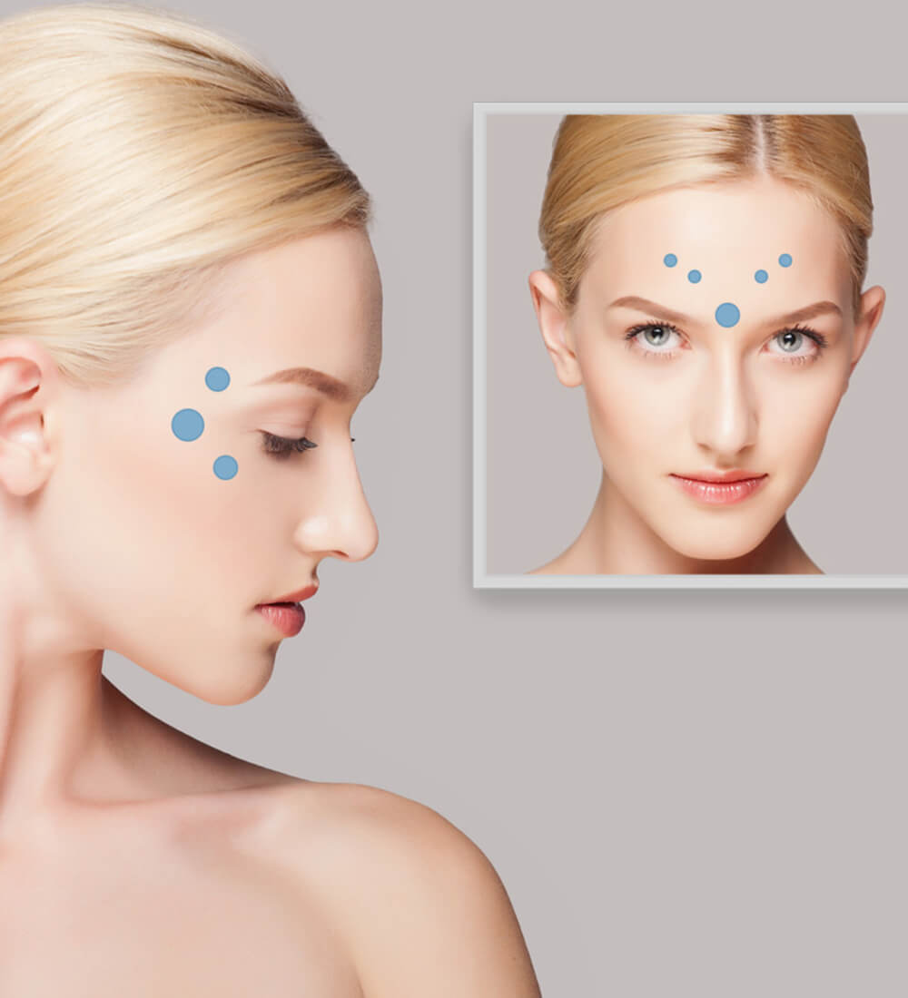 Botulino | Medicina Estetica Lusinda